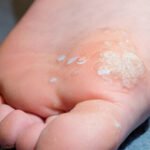 شكل الثالول بالصور؛ التعرف على 7 أنواع من الثآليل الجلدية